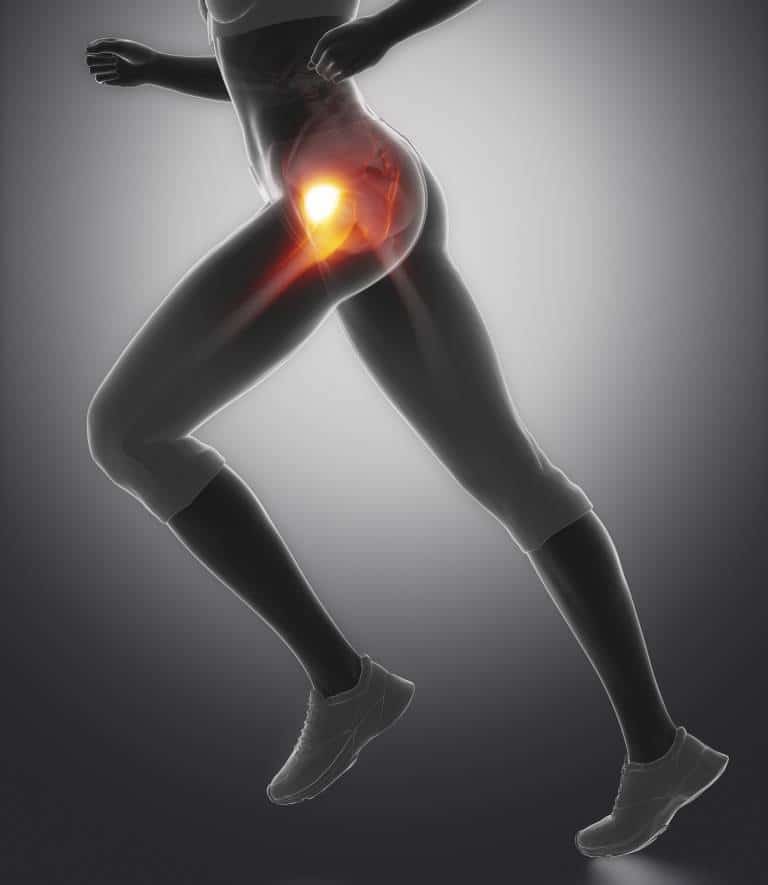 Bursite au coude, pourquoi ? Quoi faire ? | Physiothérapie - Pont-Rouge Bursite au coude, pourquoi ? Quoi faire ? | Physiothérapie - Pont-Rouge
